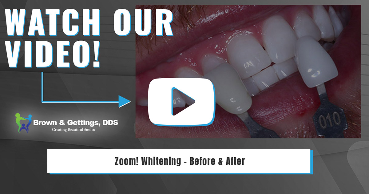 Zoom Whitening - Before and After – Freedom Dental of West Chester